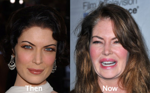53 Celebrity Plastic Surgery Gone Wrong Before And After