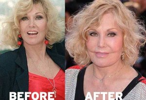 Kim Novak Plastic Surgery Before And After - Latest Plastic Surgery ...
