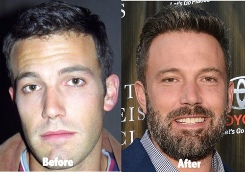 Ben Affleck Plastic Surgery Before and After Photos