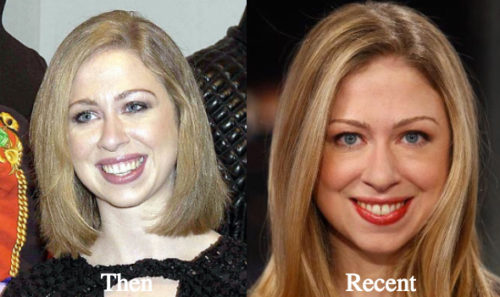 Chelsea Clinton Plastic Surgery Before and After Photos