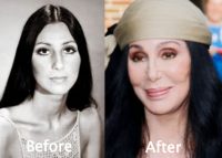 53 Celebrity Plastic Surgery Gone Wrong Before And After