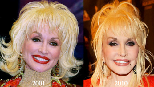 Dolly Parton Plastic Surgery Before and After Photos
