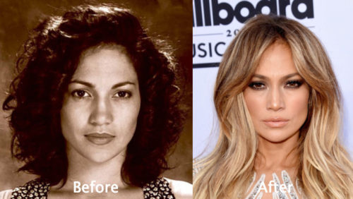 Jennifer Lopez Plastic Surgery Before and After Photos