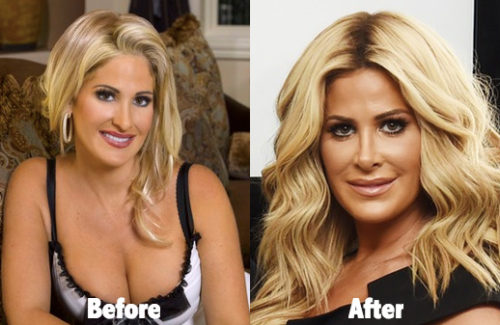 Kim Zolciak Plastic Surgery Before and After Photos