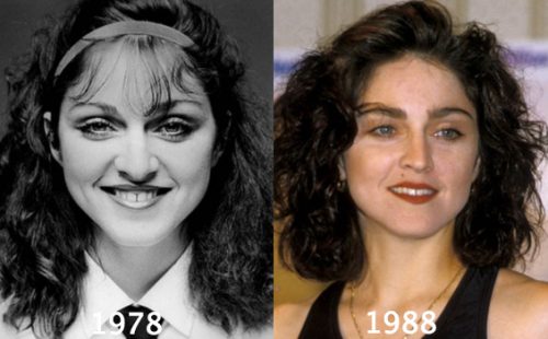 Madonna Plastic Surgery Before and After Photos
