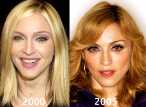 Madonna Plastic Surgery Before and After Photos