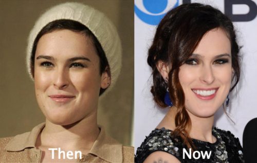 Rumer Willis Plastic Surgery Before and After Photos