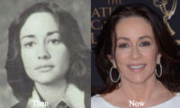Patricia Heaton Plastic Surgery Before and After Photos