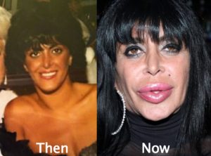 Big Ang Plastic Surgery Before and After Photos