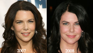 Lauren Graham Plastic Surgery Before and After Photos