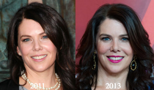 Lauren Graham Plastic Surgery Before and After Photos