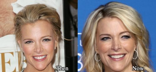 Megyn Kelly sharper nose job before and after photos - Latest Plastic ...
