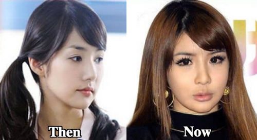 Park Bom Plastic Surgery Before and After Photos