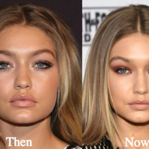 Patricia Arquette Plastic Surgery Before And After Photos – Latest ...