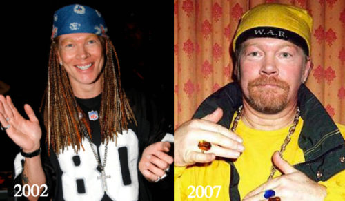Axl Rose Plastic Surgery Before and After Photos - Latest Plastic ...