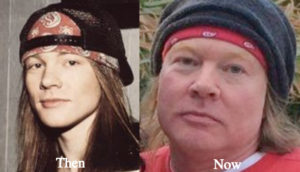 Axl Rose nose job - Latest Plastic Surgery Gossip And News. Plastic ...