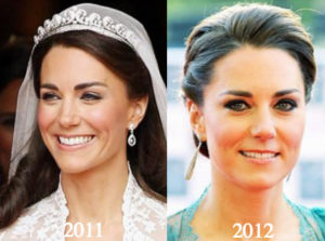 Kate Middleton Plastic Surgery Rumors - Now and Then Pictures - Latest ...