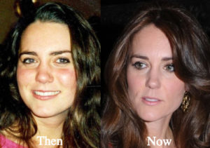 Kate Middleton Plastic Surgery before and after photos - Latest Plastic ...