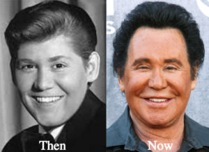 Wayne Newton Plastic Surgery Before and After Photos - Latest Plastic ...