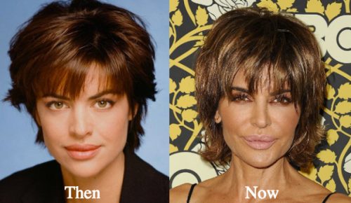 Lisa Rinna Plastic Surgery Before and After Photos - Latest Plastic ...