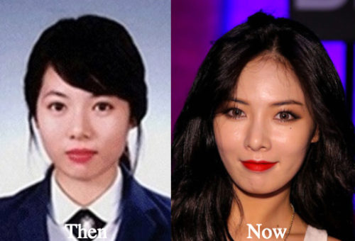 Hyuna Plastic Surgery Before and After Photos - Latest Plastic Surgery ...
