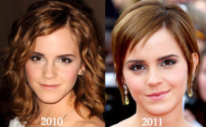 Emma Watson Boob Job and Other Plastic Surgery Before and After ...