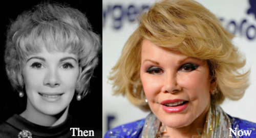 Joan Rivers Plastic Surgery Before and After Photos - Latest Plastic ...