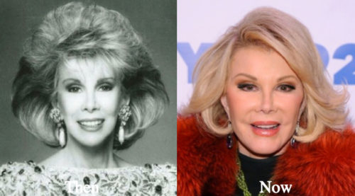 Joan Rivers Plastic Surgery Before and After Photos - Latest Plastic ...