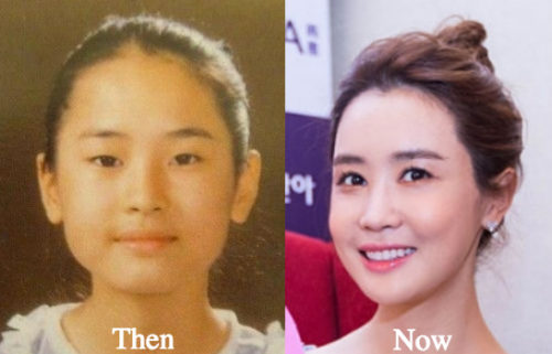 Lee Da Hae Plastic Surgery Before and After Photos - Latest Plastic ...