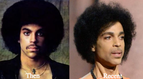 prince-facial-fillers-rumors - Latest Plastic Surgery Gossip And News ...