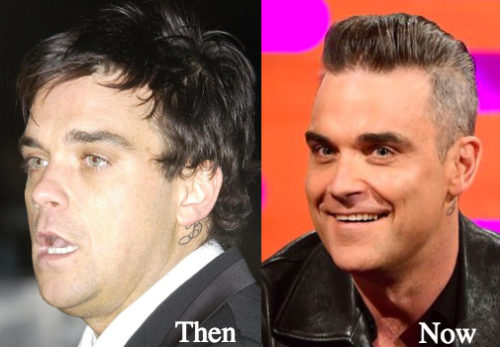robbie-williams-botox-facial-fillers - Latest Plastic Surgery Gossip ...