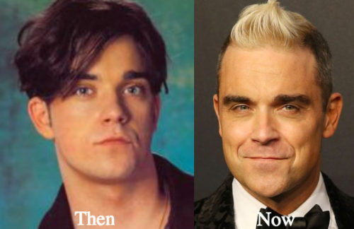 Robbie Williams Plastic Surgery Before and After Photos - Latest ...