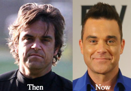 Robbie Williams Plastic Surgery Before and After Photos - Latest ...