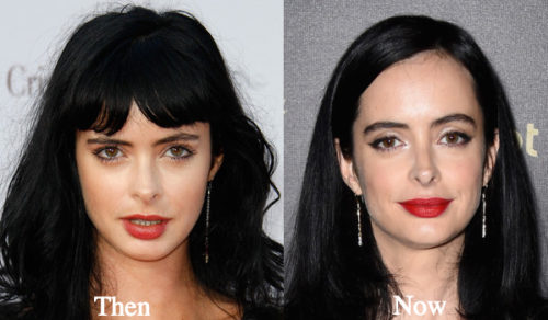 Krysten Ritter Plastic Surgery Before and After Photos - Latest Plastic ...
