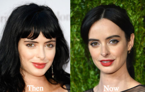 Krysten Ritter Plastic Surgery Before and After Photos - Latest Plastic ...