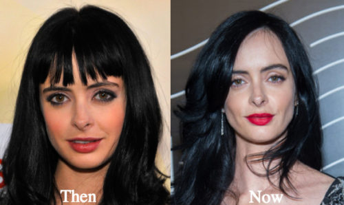 Krysten Ritter Plastic Surgery Before and After Photos - Latest Plastic ...