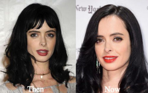 Krysten Ritter Plastic Surgery Before and After Photos - Latest Plastic ...
