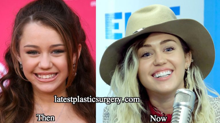 Miley Cyrus Teeth - Did Miley Cyrus Fix Her Teeth? - Latest Plastic ...