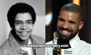 Drake Nose Job Rumors - True or False? - Latest Plastic Surgery Gossip ...