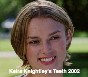 Keira Knightley Teeth Alignment - Did She Undergo teeth plastic surgery ...