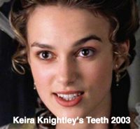Keira Knightley Teeth Alignment - Did She Undergo teeth plastic surgery ...