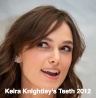 Keira Knightley Teeth Alignment - Did She Undergo teeth plastic surgery ...