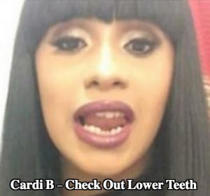 Cardi B Teeth - Did She Fix Them? - Latest Plastic Surgery Gossip And ...